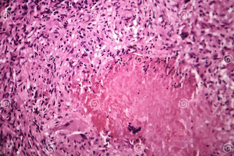 Caseous Pneumonia, Light Micrograph Stock Image - Image of ...