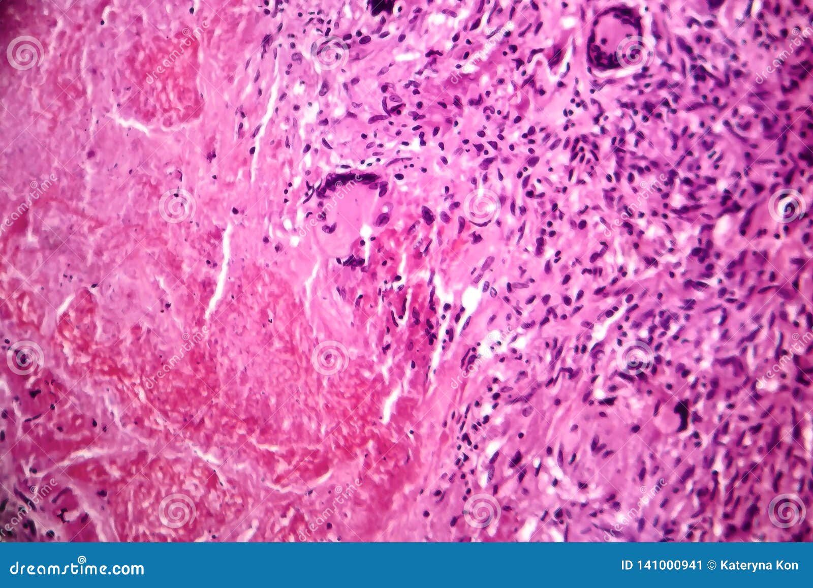 Caseous Pneumonia, Light Micrograph Stock Image - Image of ...