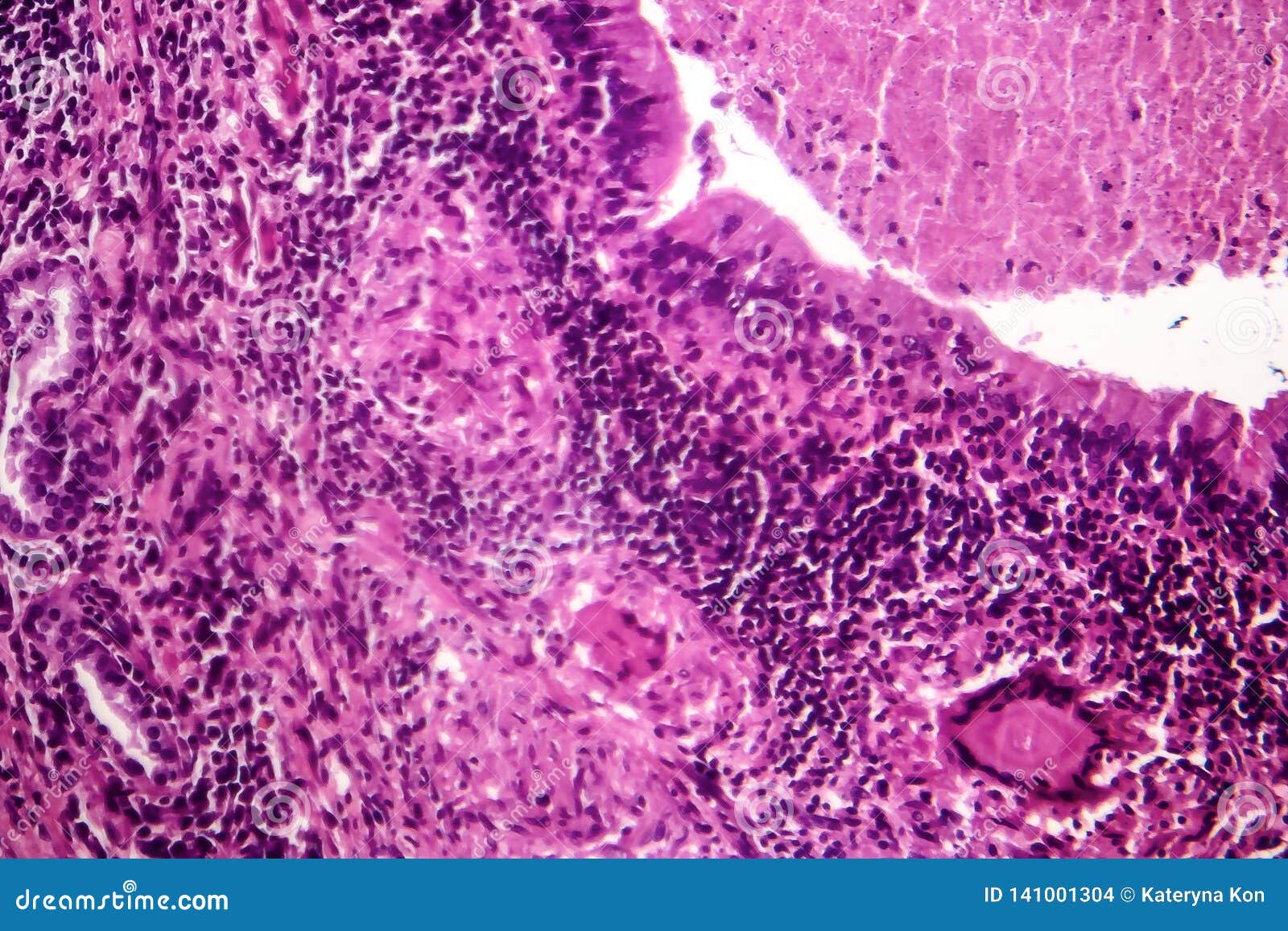 Caseous Pneumonia, Light Micrograph Stock Photo - Image of ...