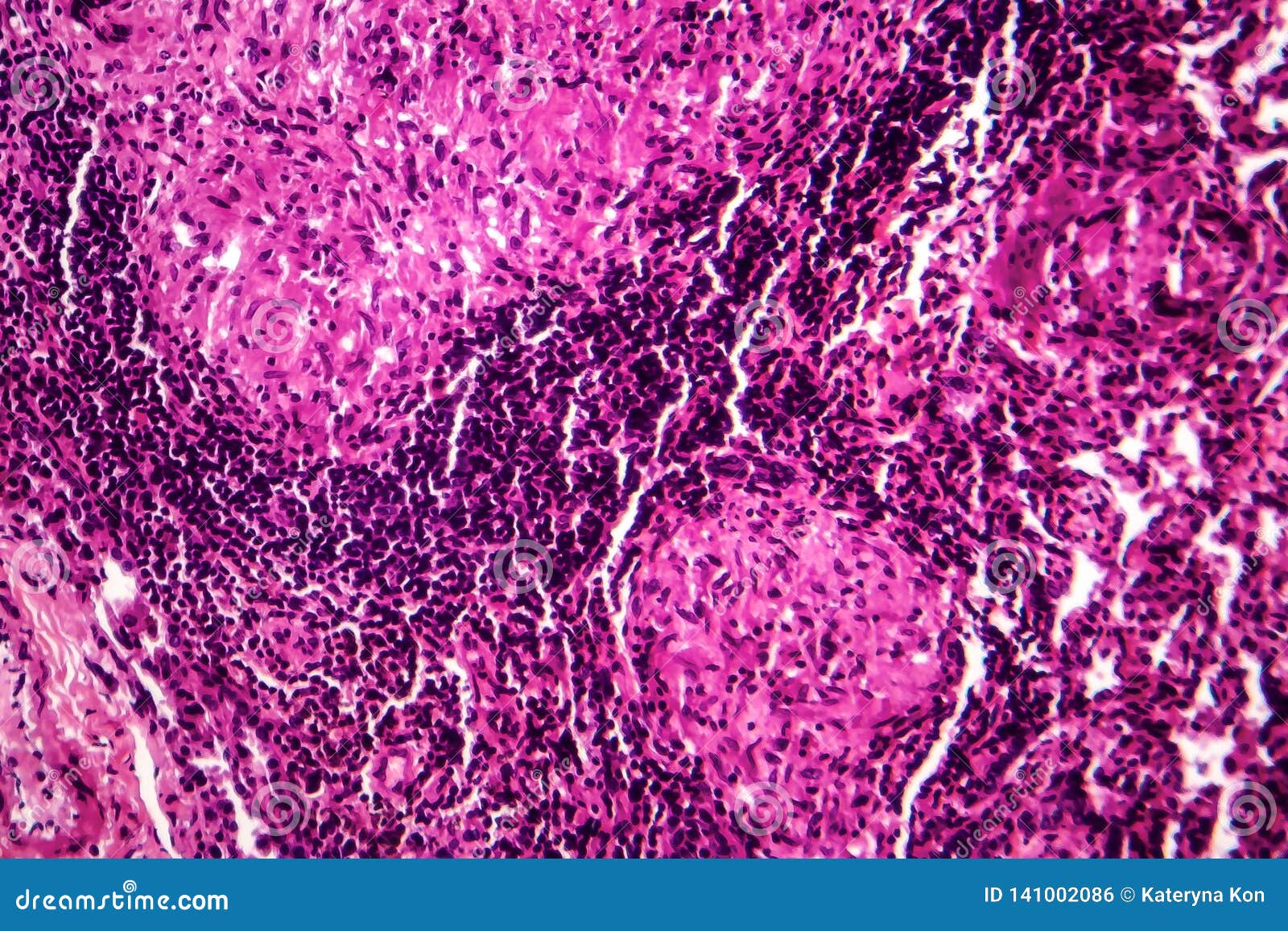 Caseous Pneumonia, Light Micrograph Stock Photo - Image of pathogen ...