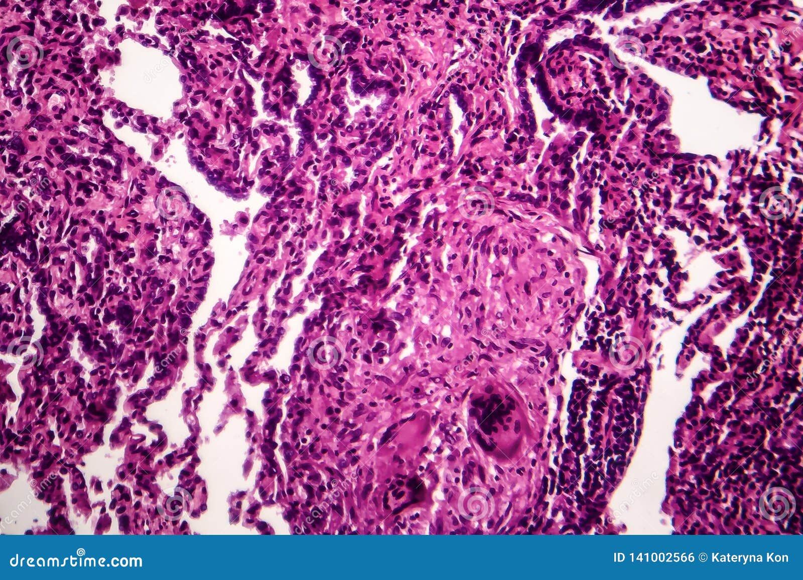 Caseous Pneumonia, Light Micrograph Stock Photo - Image of morphology ...