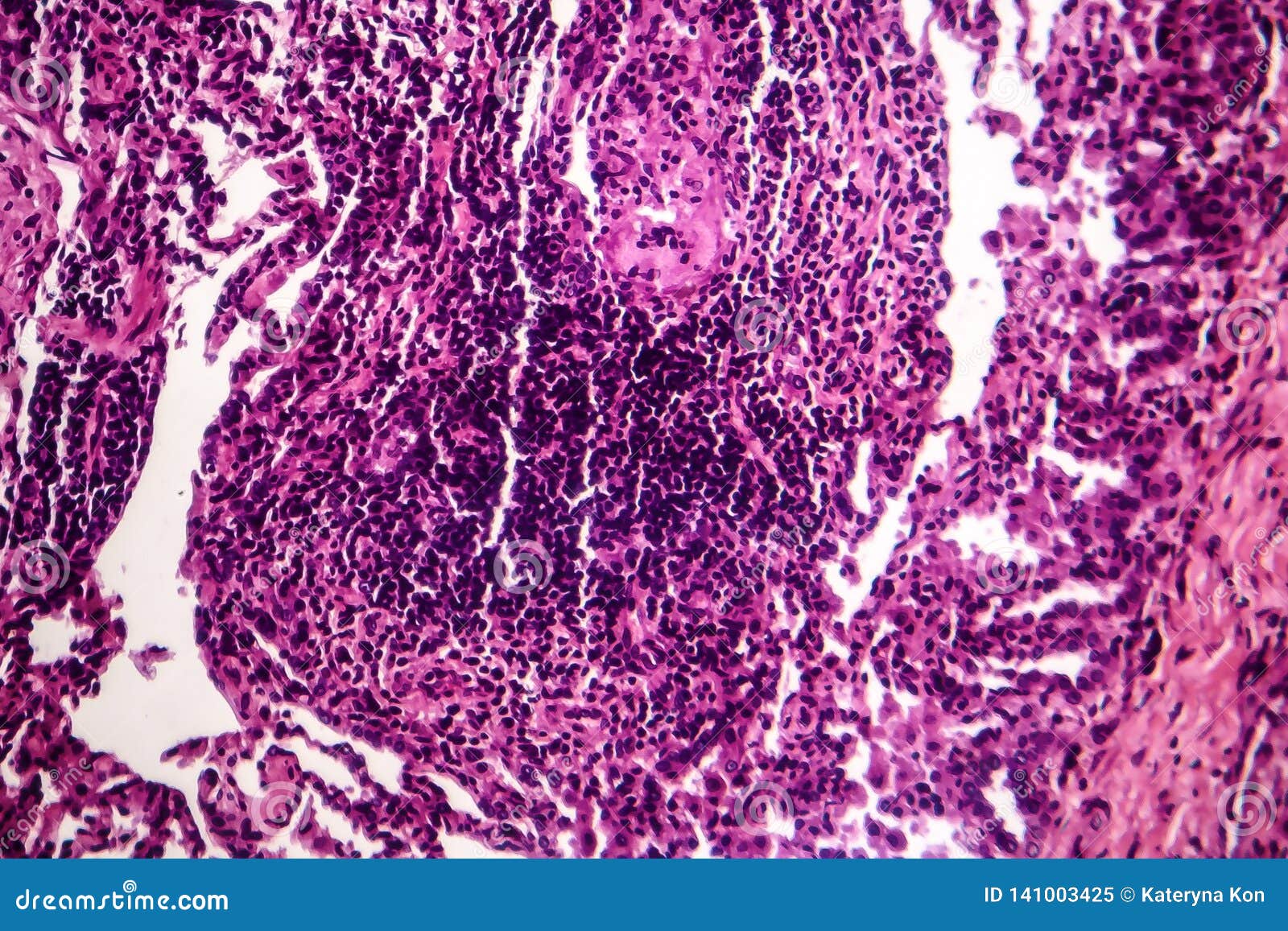 Caseous Pneumonia, Light Micrograph Stock Image - Image of morphology ...