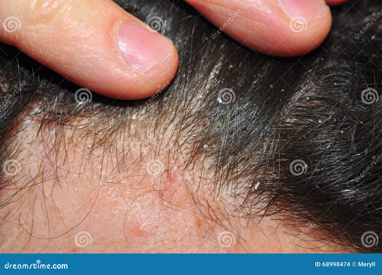 Caspa Do Problema Da Pele Do Cabelo Foto de Stock - Imagem de detalhe ...