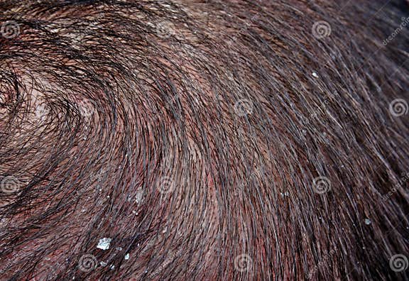 Caspa en el pelo foto de archivo. Imagen de caspa, hombre - 37229478