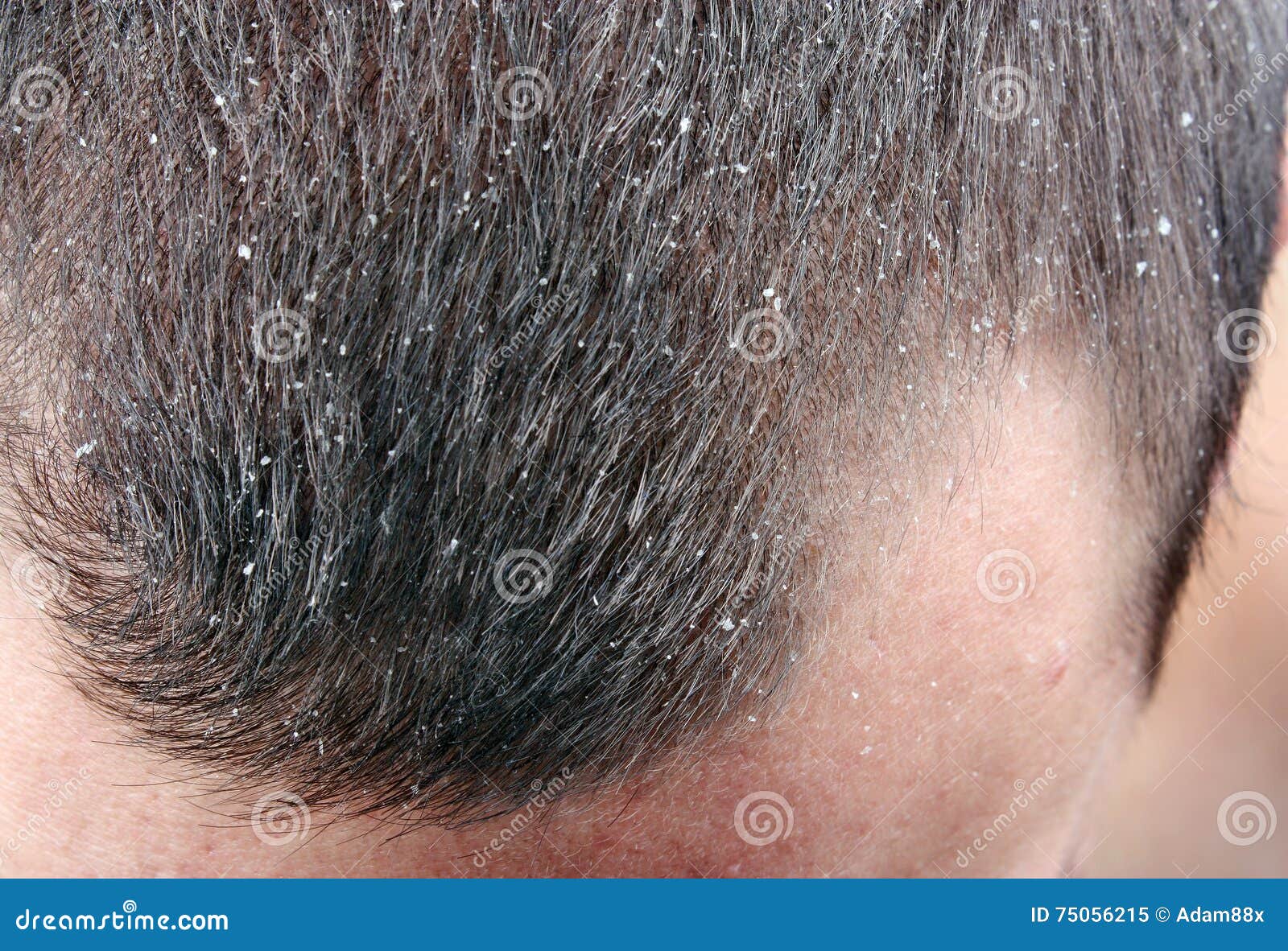 Caspa en el pelo imagen de archivo. Imagen de muchacho - 75056215