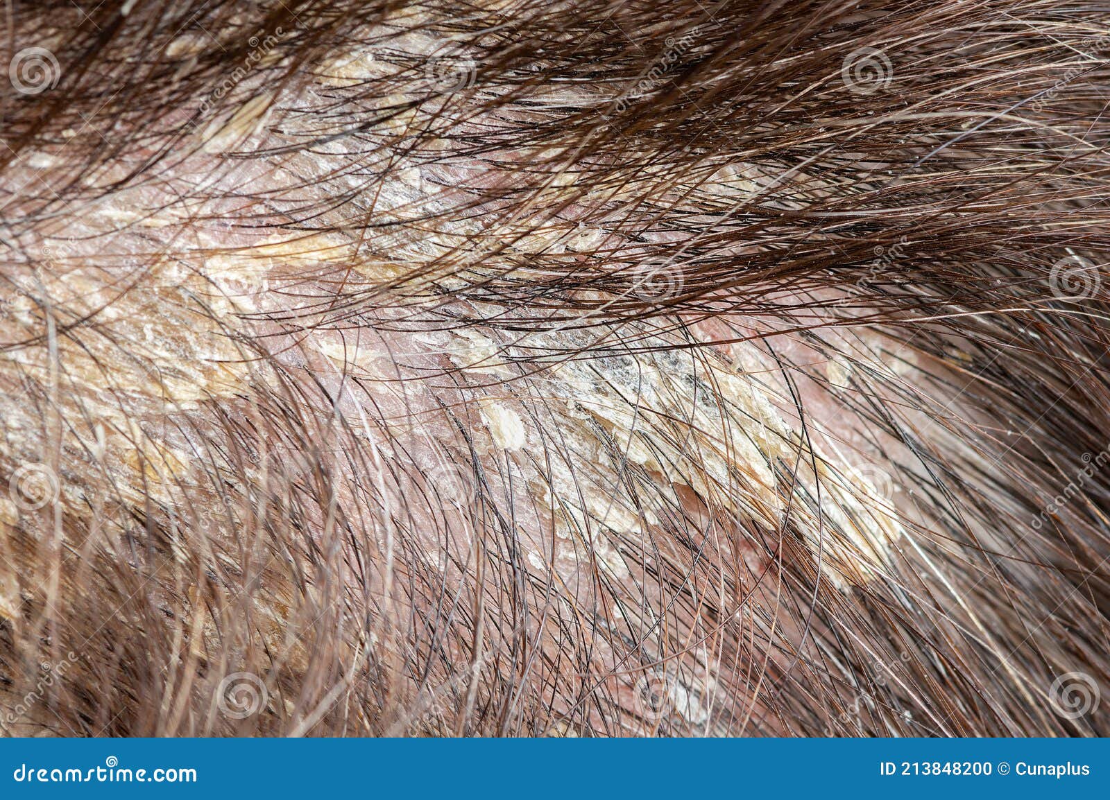 Caspa No Cabelo E No Couro Cabeludo Foto de Stock - Imagem de caspa ...