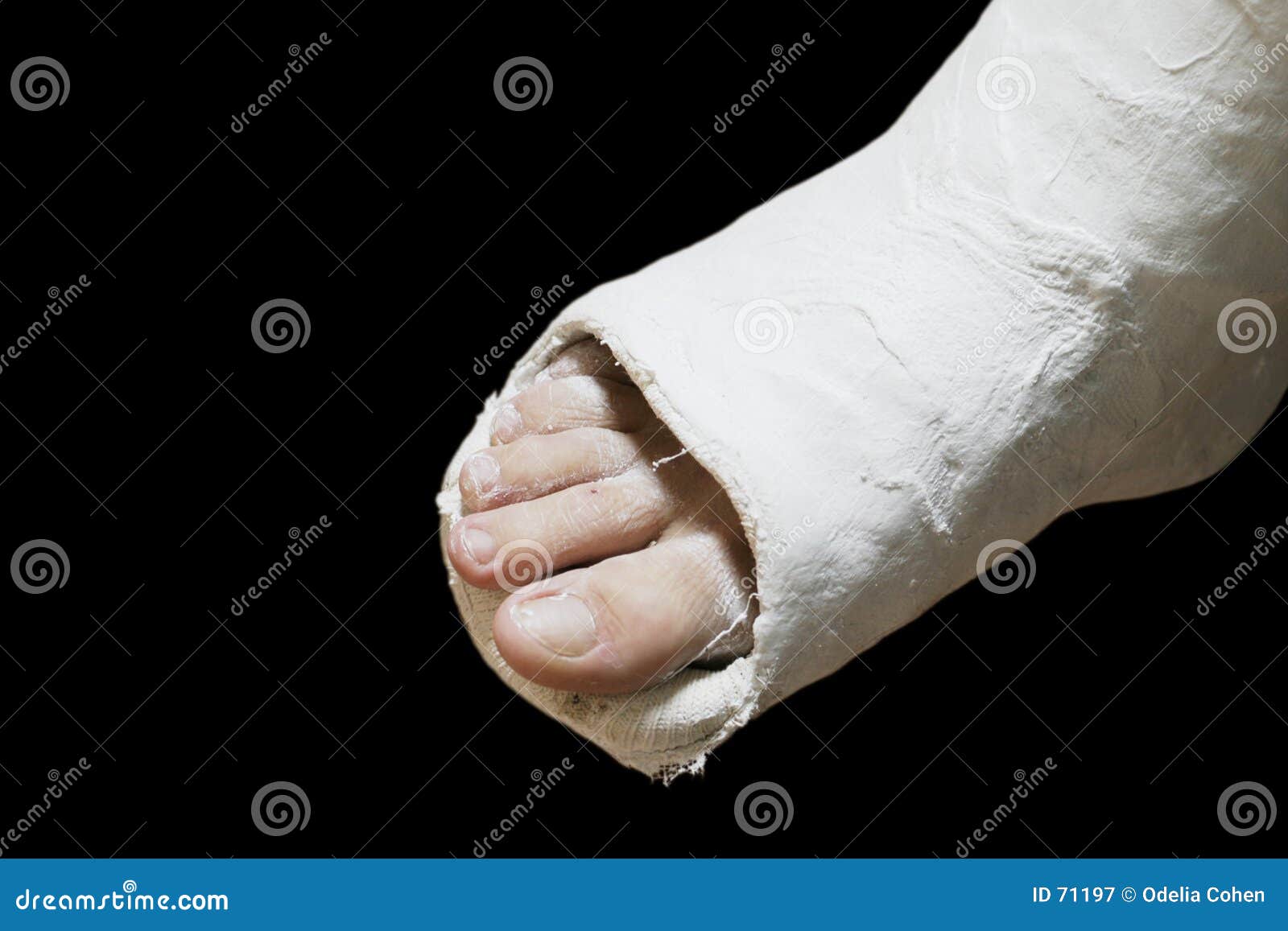Cast stock image. Image of broken, painful, injury, bone - 71197