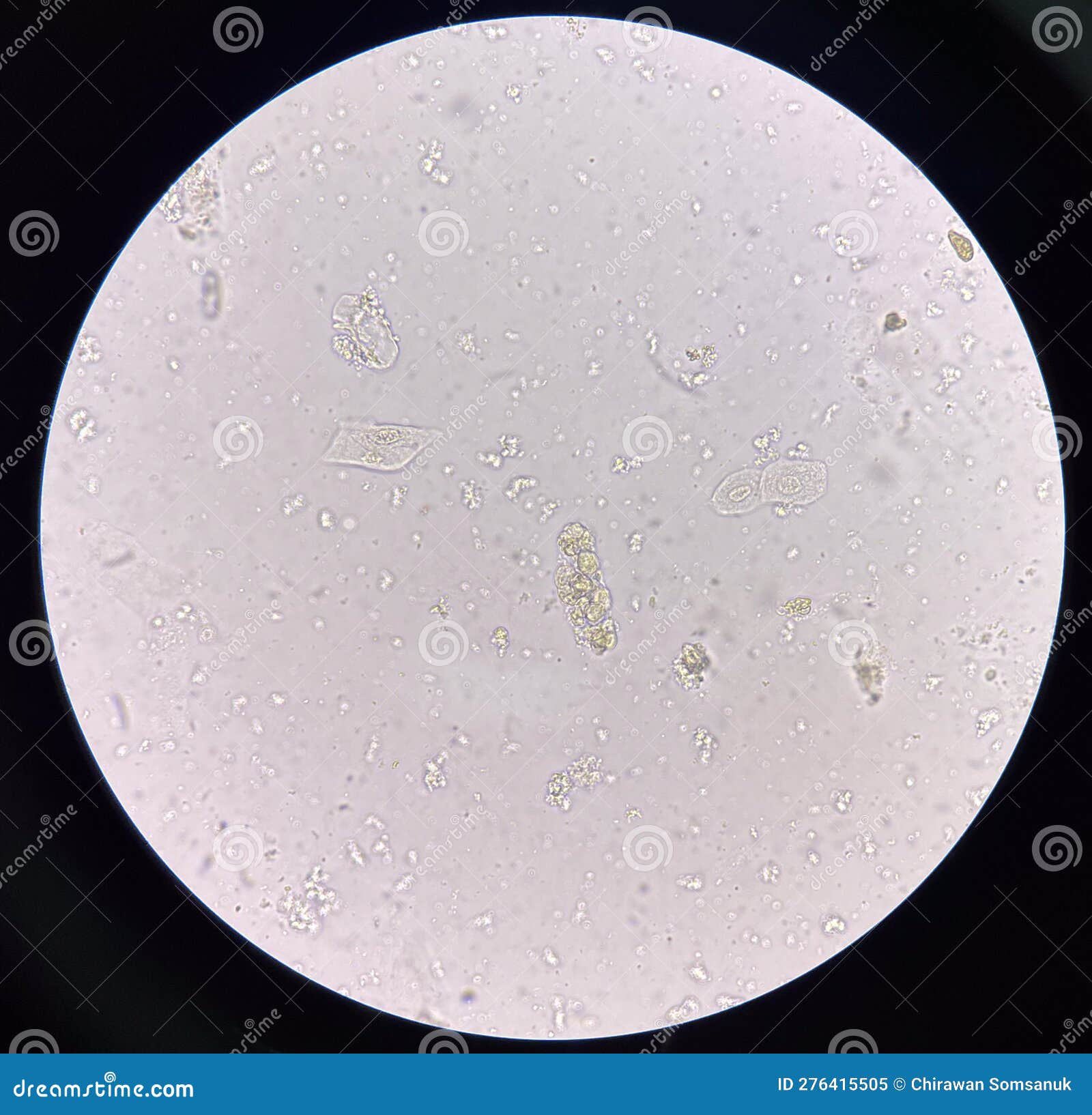 Cast in Fresh Urine Finding with Microscope Stock Image - Image of ...