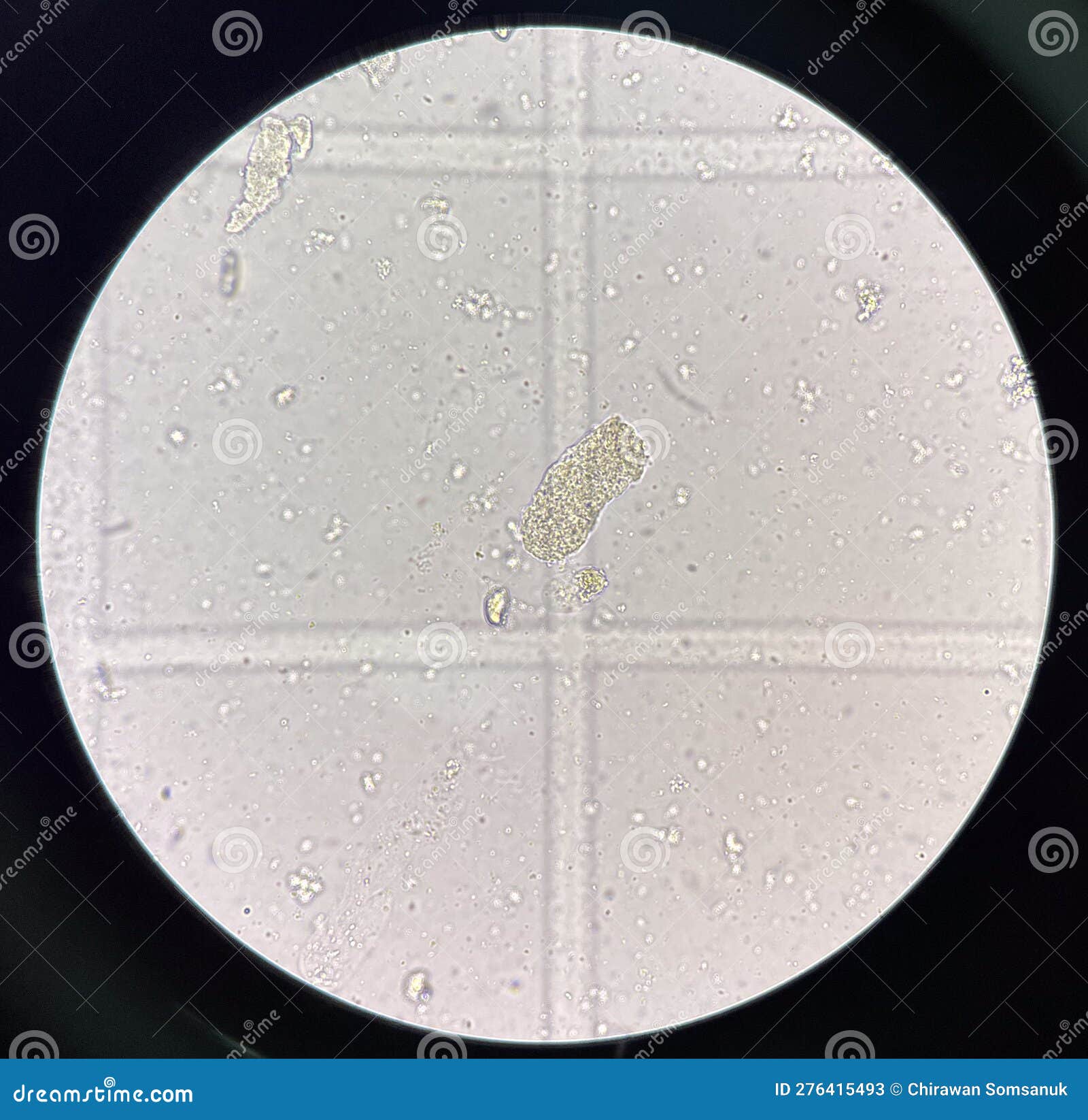 Cast in Fresh Urine Finding with Microscope Stock Image - Image of ...