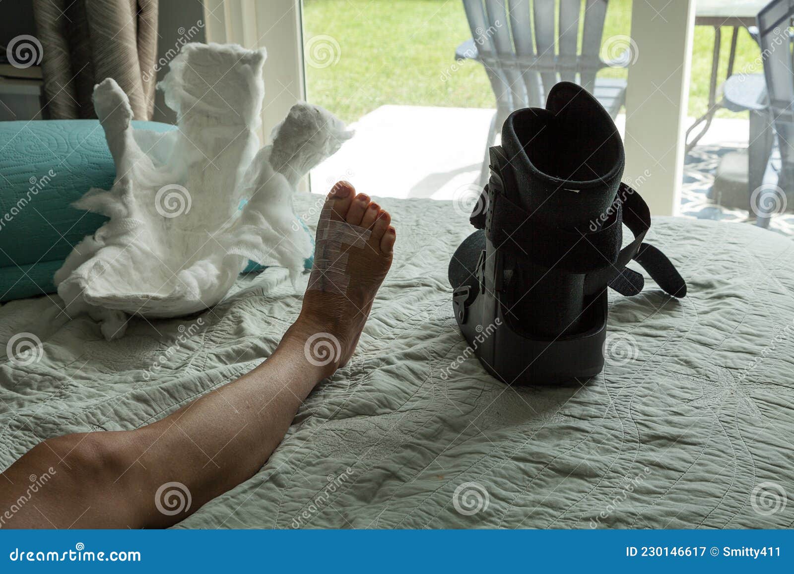 Cast Removed from a Foot after Bunion Surgery Stock Image - Image of ...