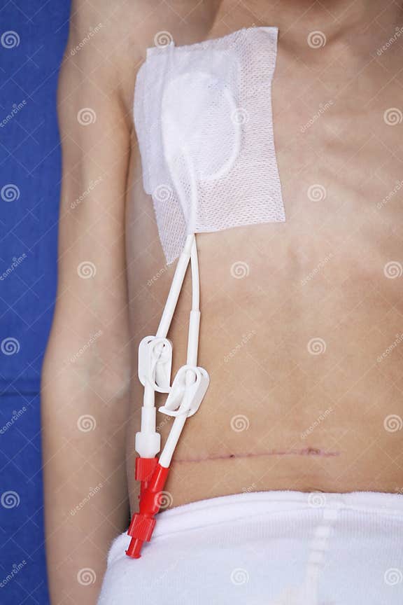 Catéter de Hickman imagen de archivo. Imagen de hermoso - 19005523