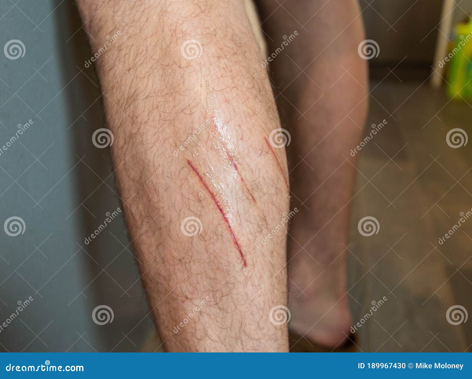 Cat Bite Marks and Scratches from Attack Stock Photo - Image of ...