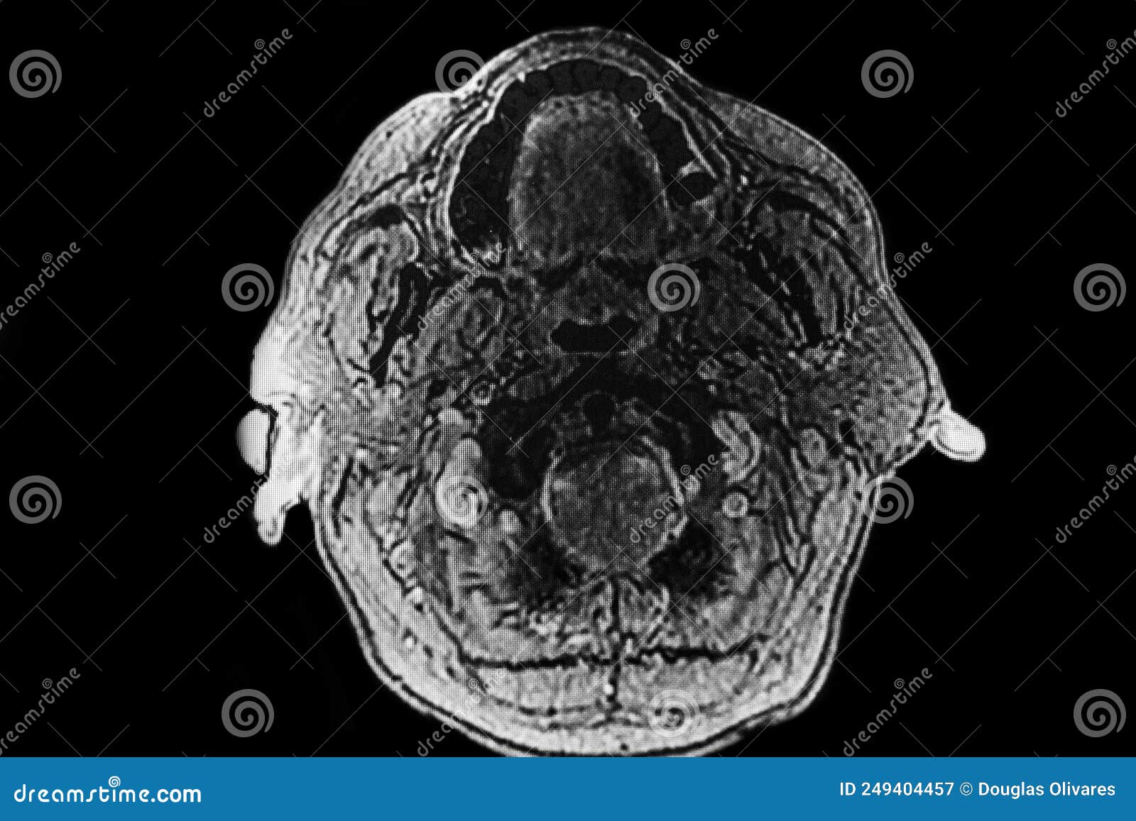 CAT - Scan of brain tumor. stock image. Image of brain - 249404457