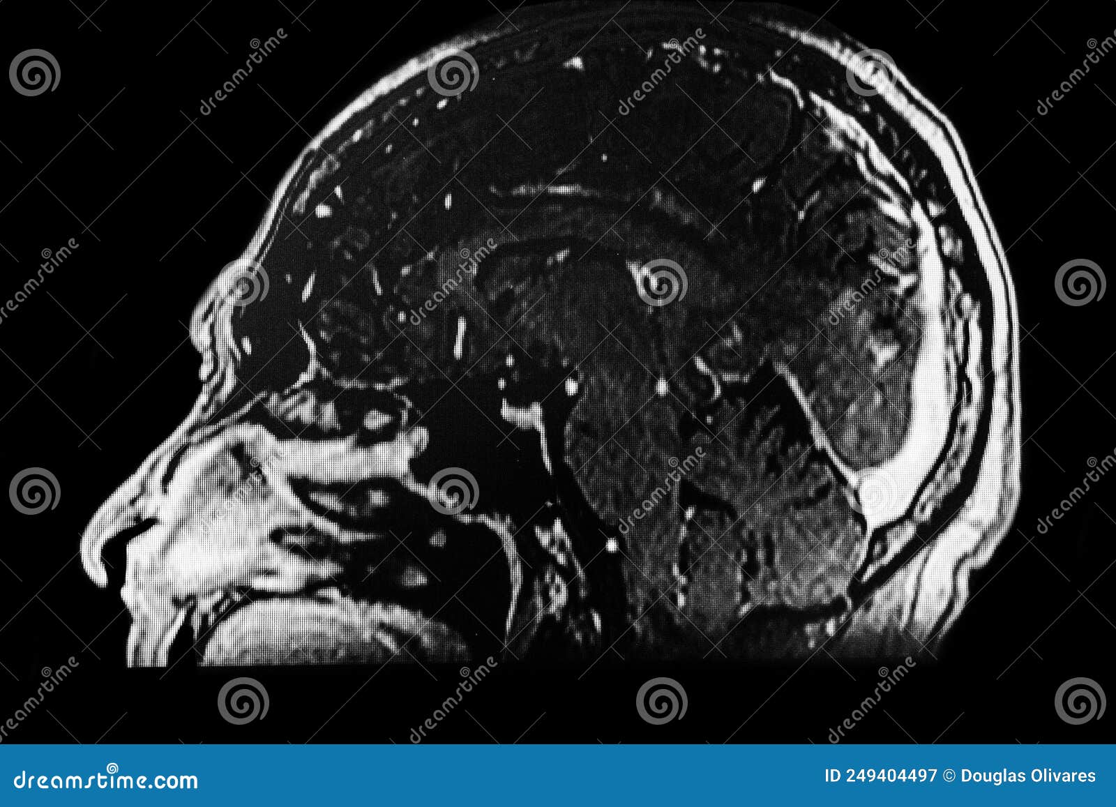 CAT - Scan of brain tumor. stock image. Image of hospital - 249404497