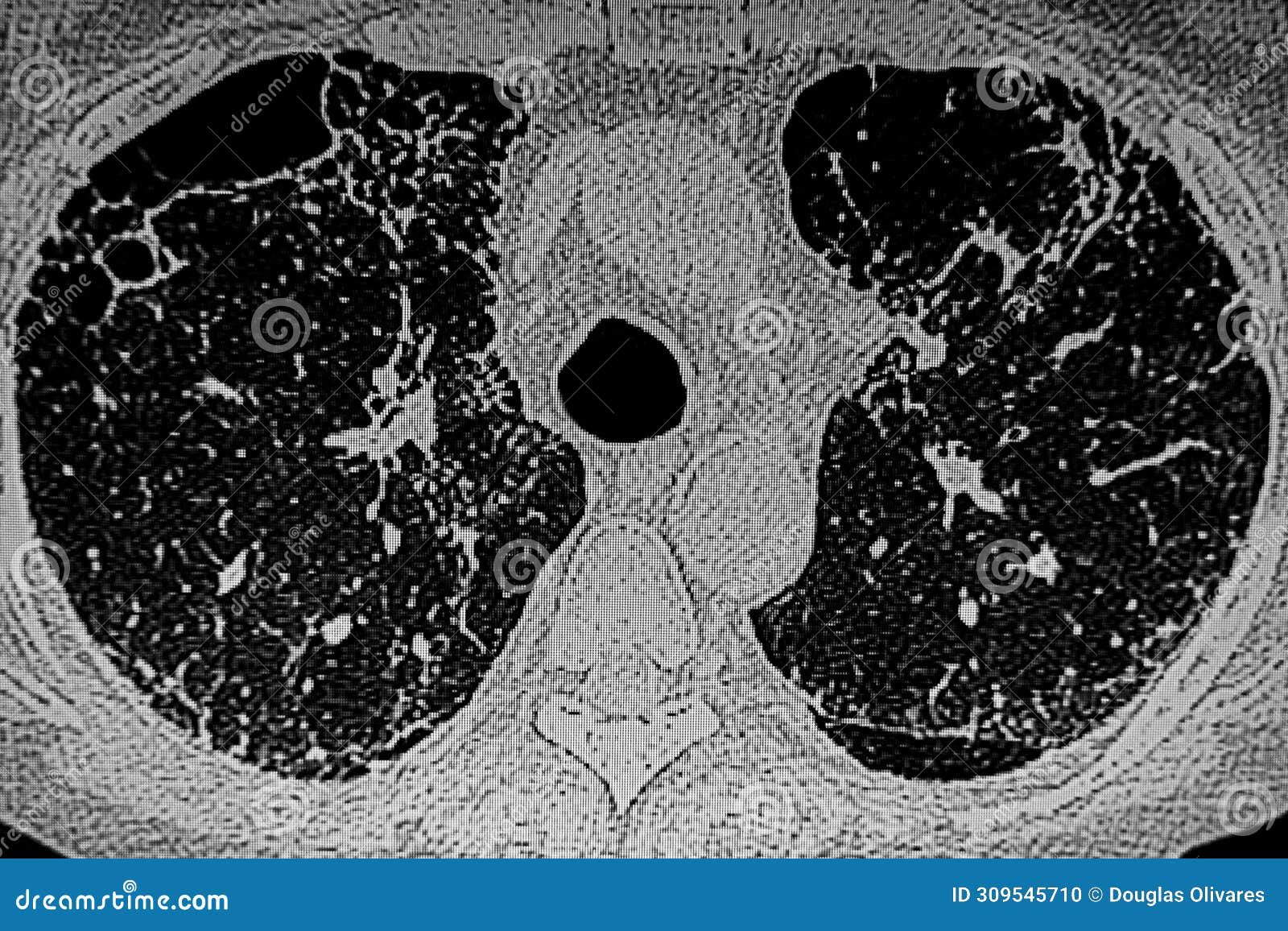CAT- Scan of Interstitial Lung Disease Secondary To Scleroderma. Stock ...