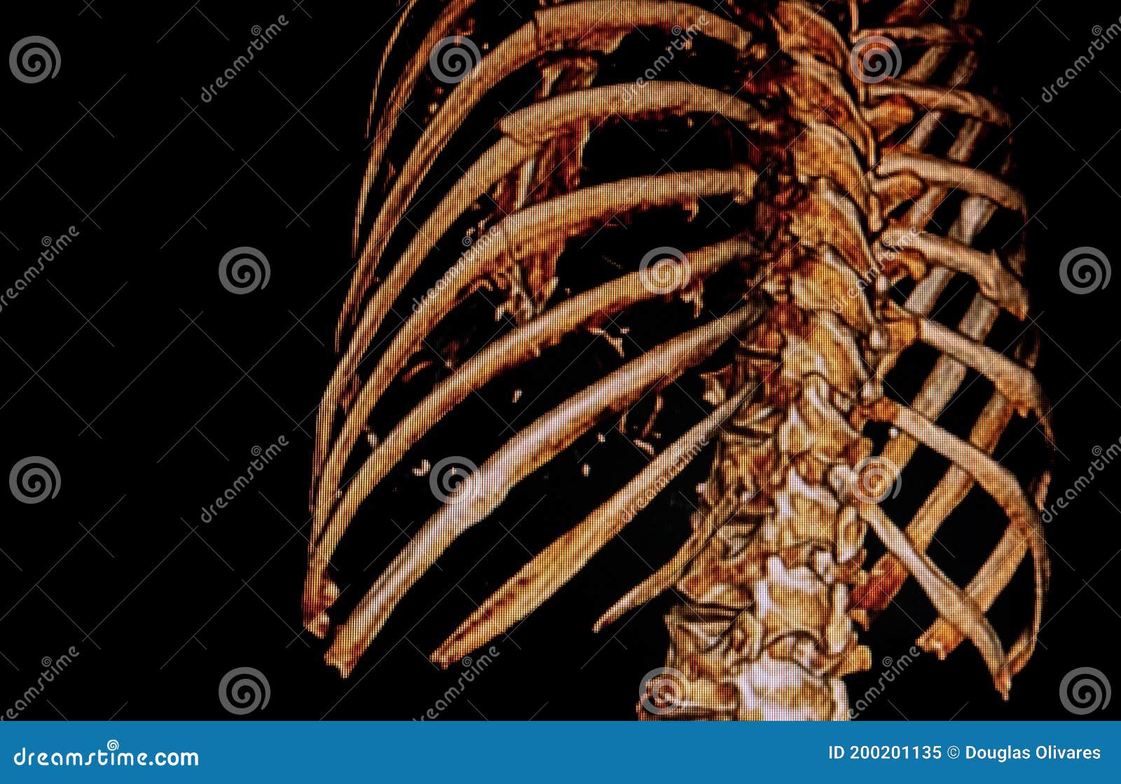 Cat Scan Of Rib Fracture Stock Image Image Of Skeleton 200201135