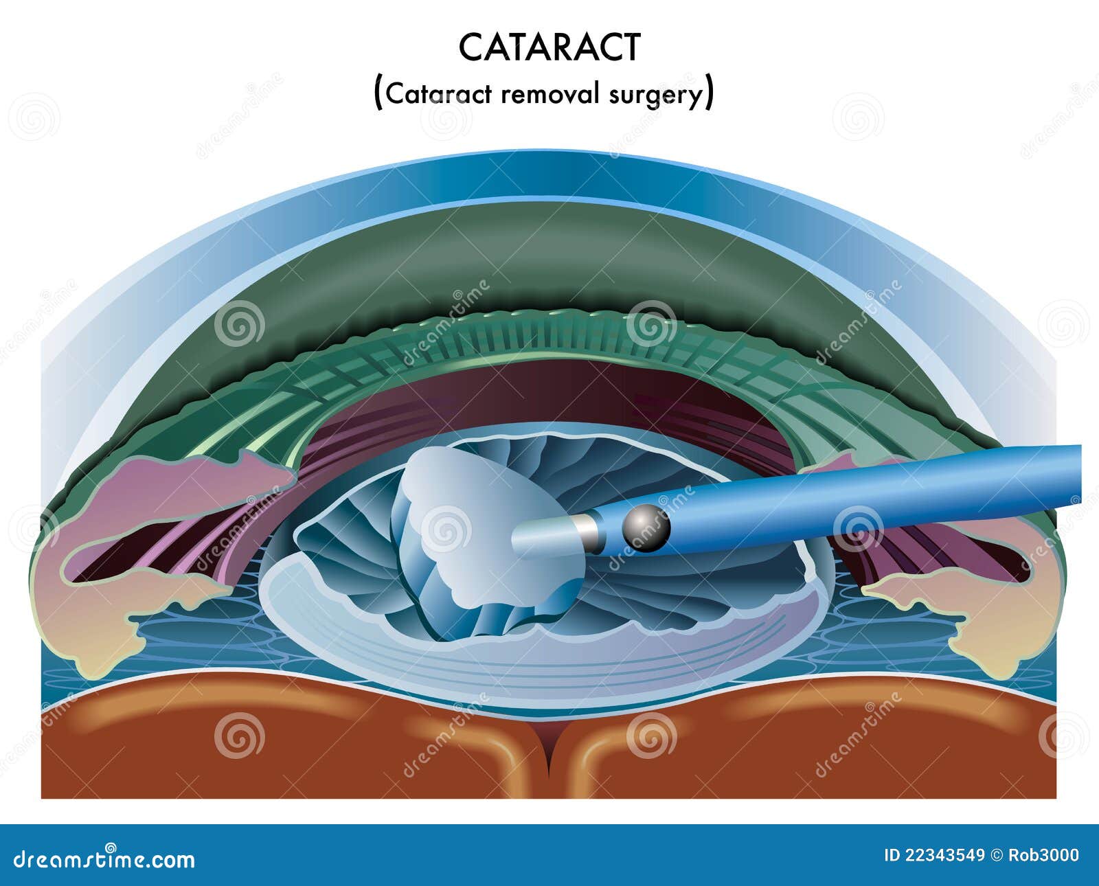 Cataract stock vector. Illustration of glaucoma, diabetes - 22343549