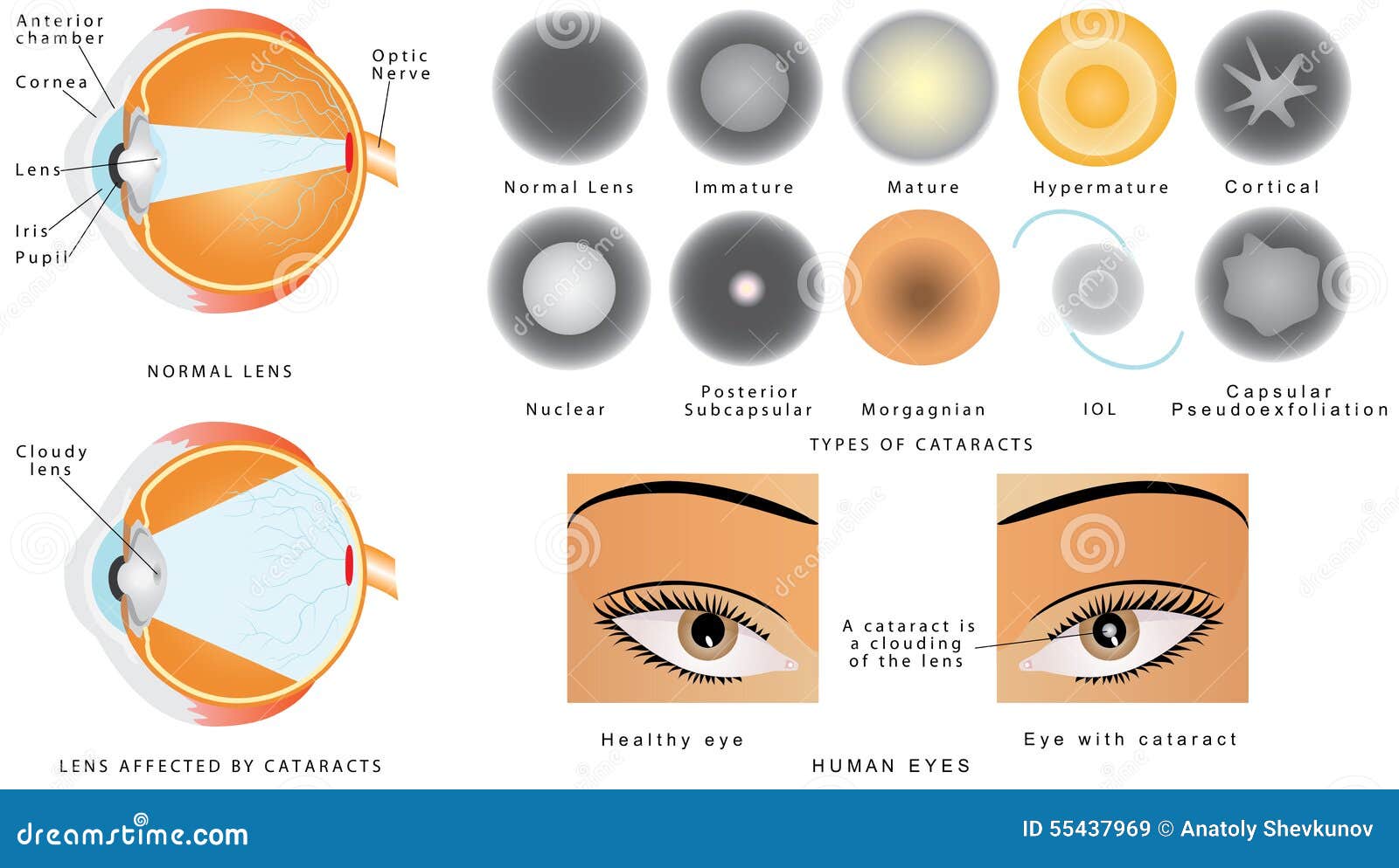 Cataract ilustração do vetor. Ilustração de retina, humano - 55437969