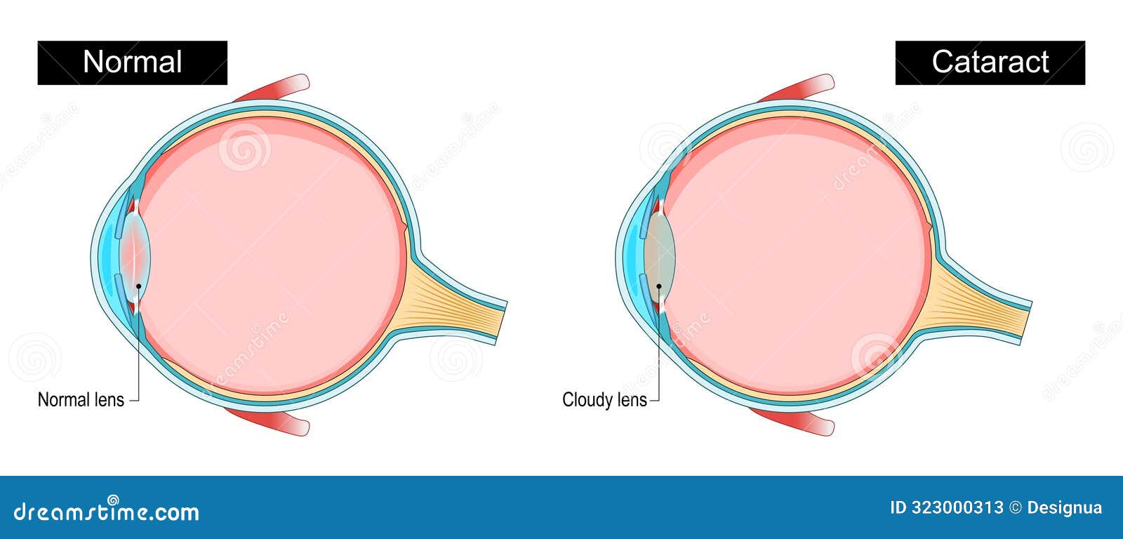 Cataract. Cross Section Of A Human Eye Cartoon Vector | CartoonDealer ...
