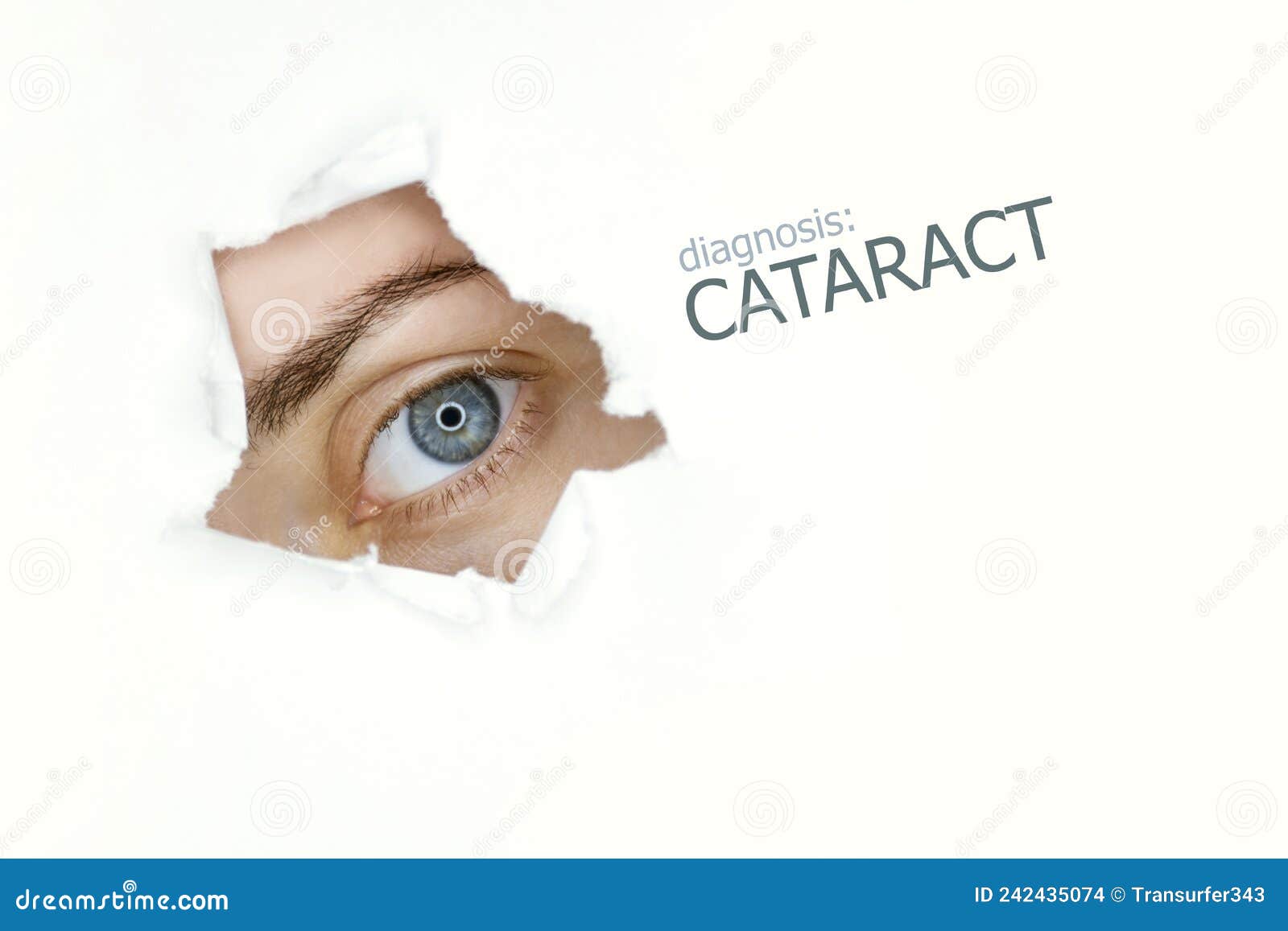 Cataract Disease Poster with Blue Eye on Left Stock Illustration ...