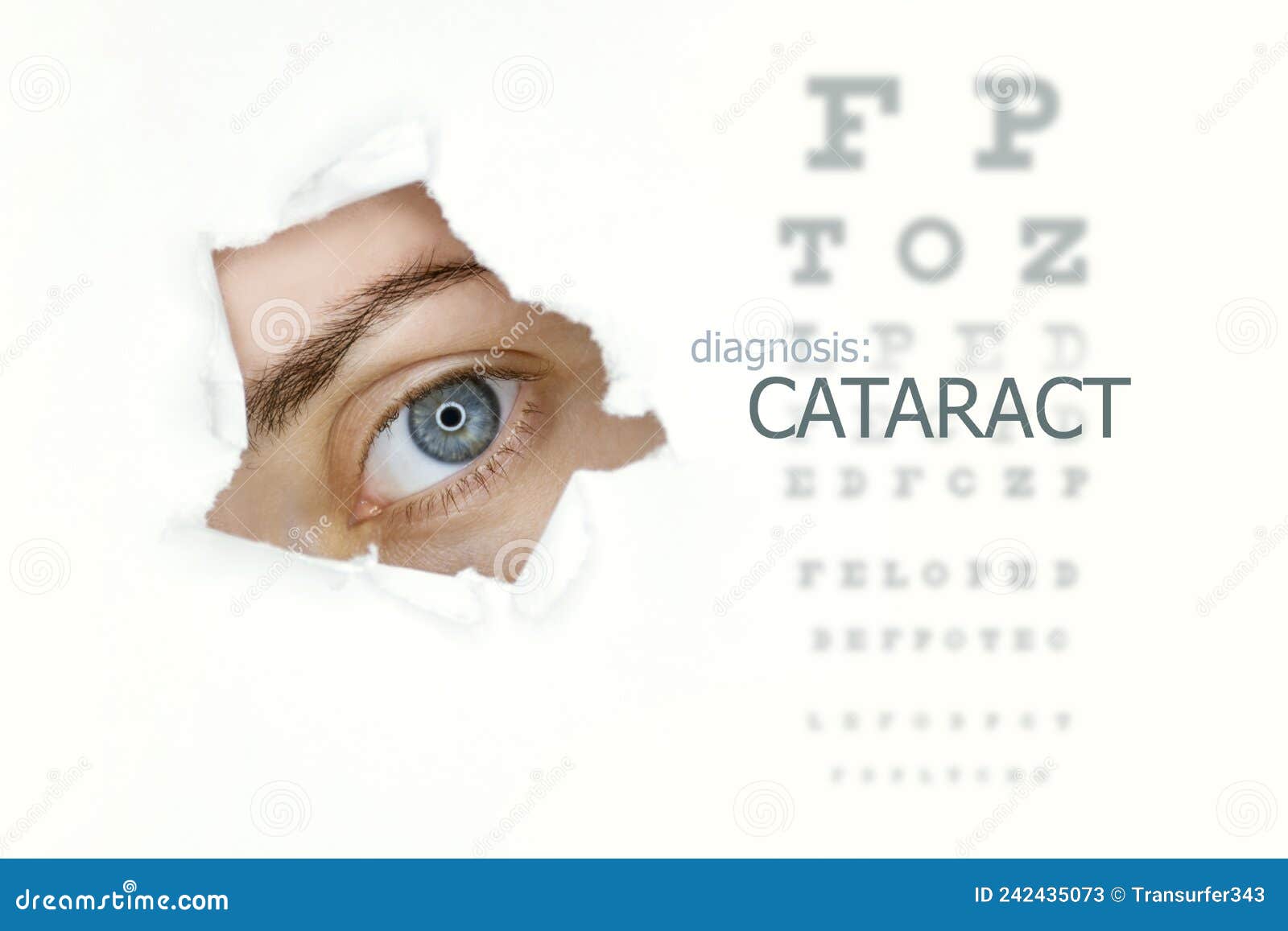 Cataract Disease Poster with Eye Test Chart and Blue Eye on Left Stock ...