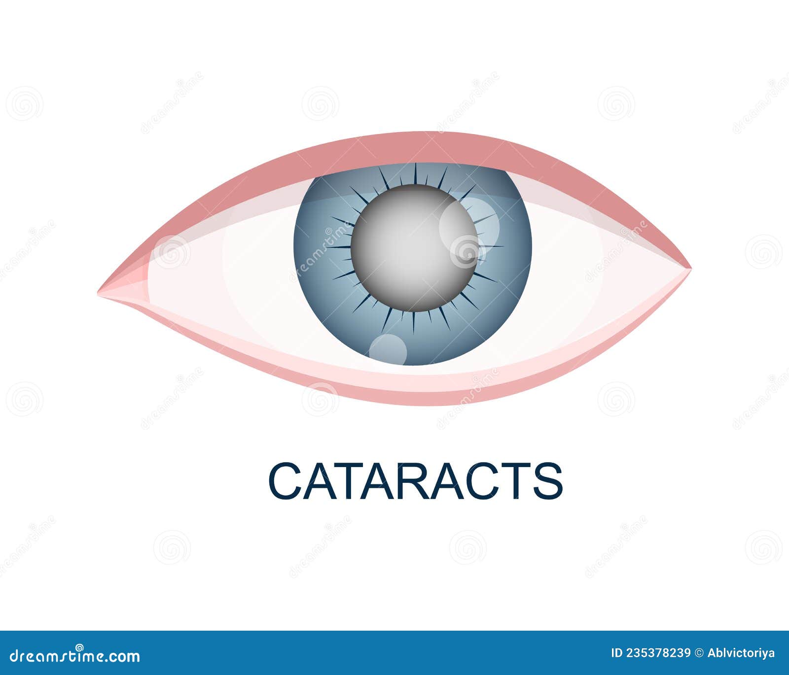Cataract Eye Close Up View. Eyeball with Cloudy Lens. Anatomically ...