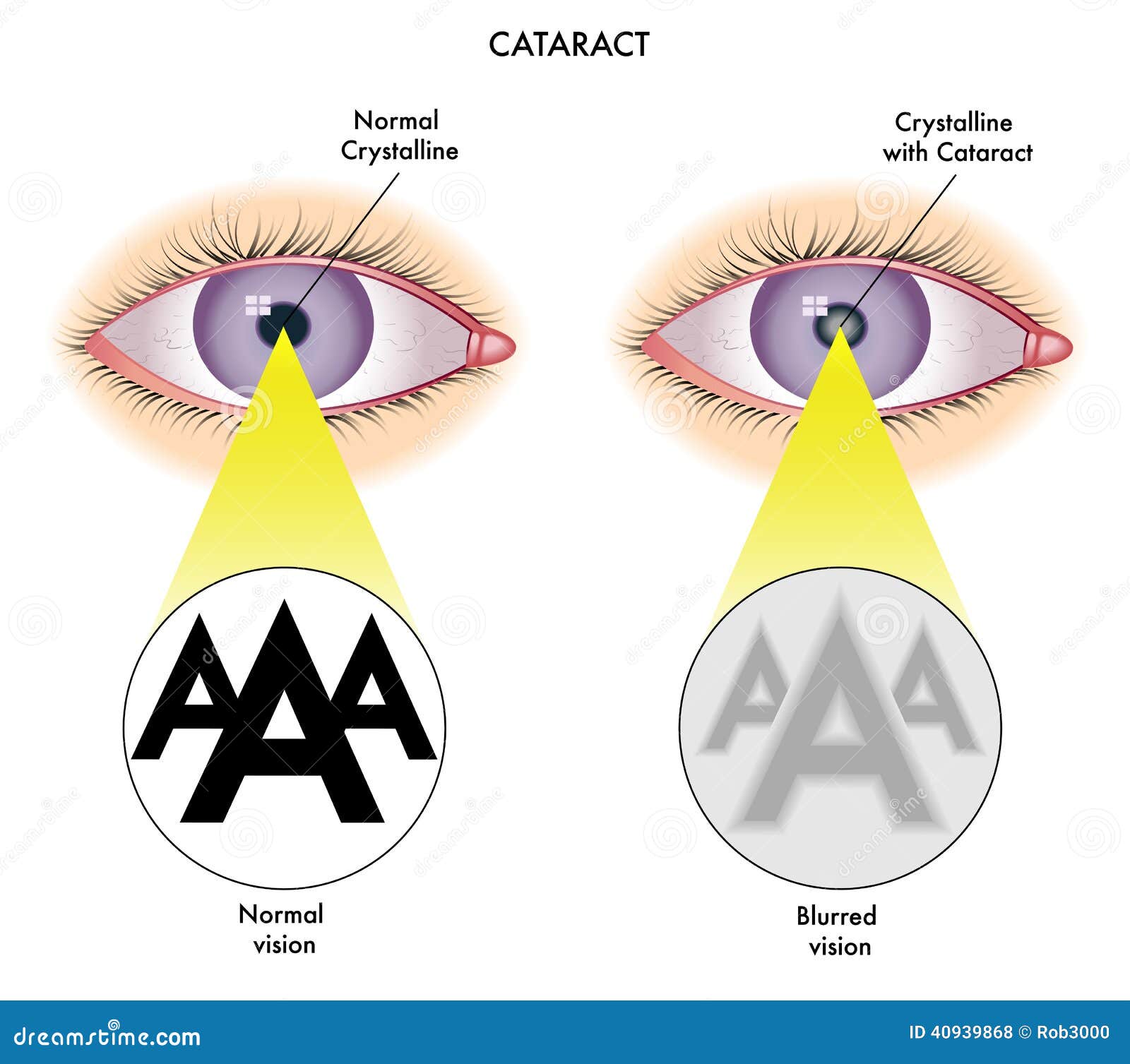 Eye - Cataracts & Glaucoma Royalty-Free Stock Photography ...