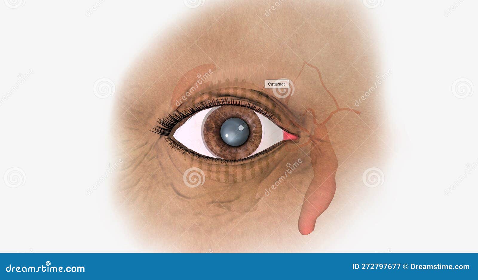 A Cataract is the Progressive Clouding of the Lens of the Eye ...