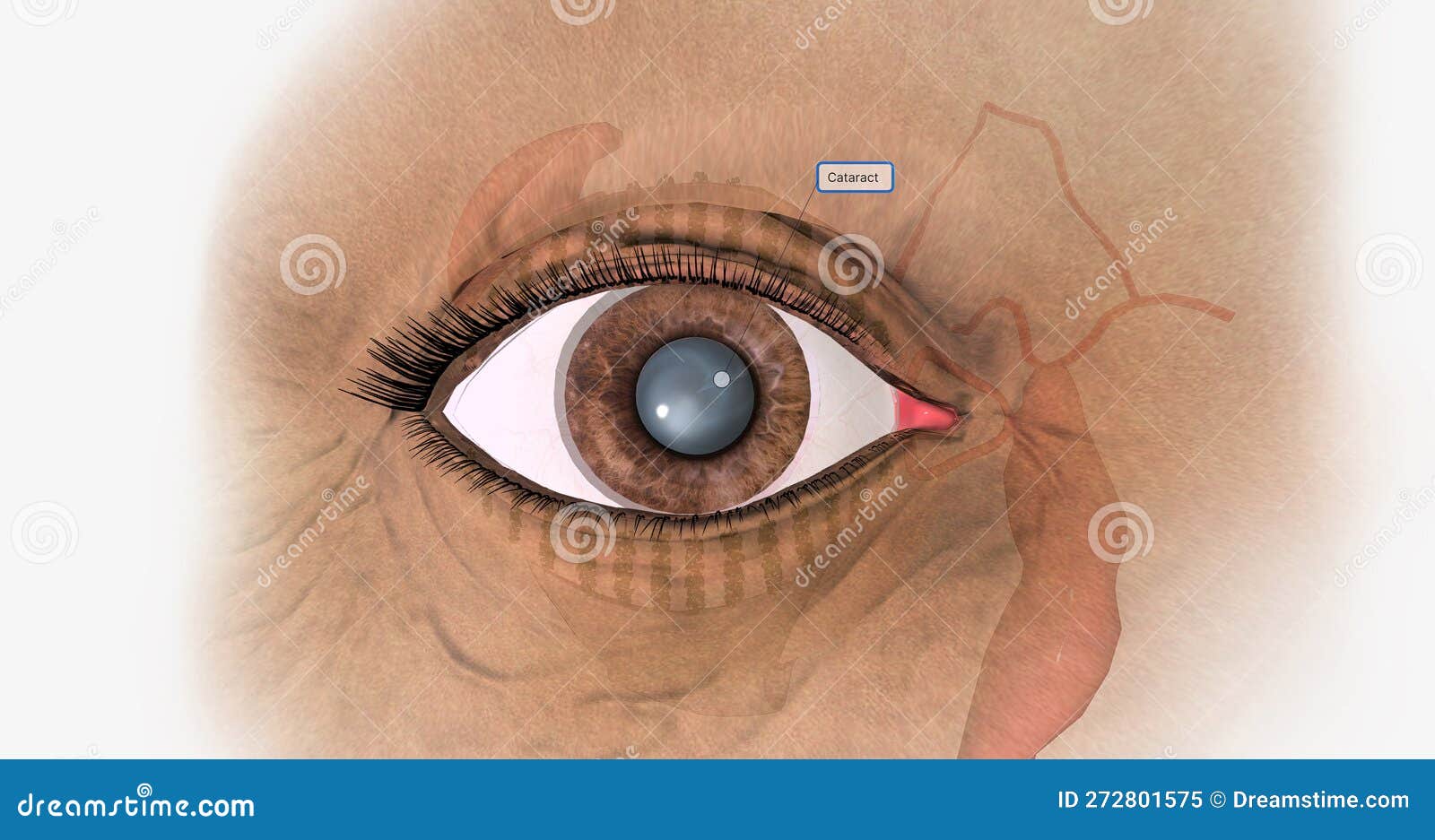 A Cataract is the Progressive Clouding of the Lens of the Eye ...