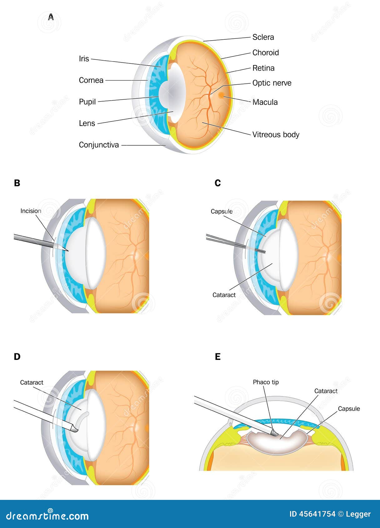 Cataract. Cross Section Of A Human Eye Cartoon Vector | CartoonDealer ...