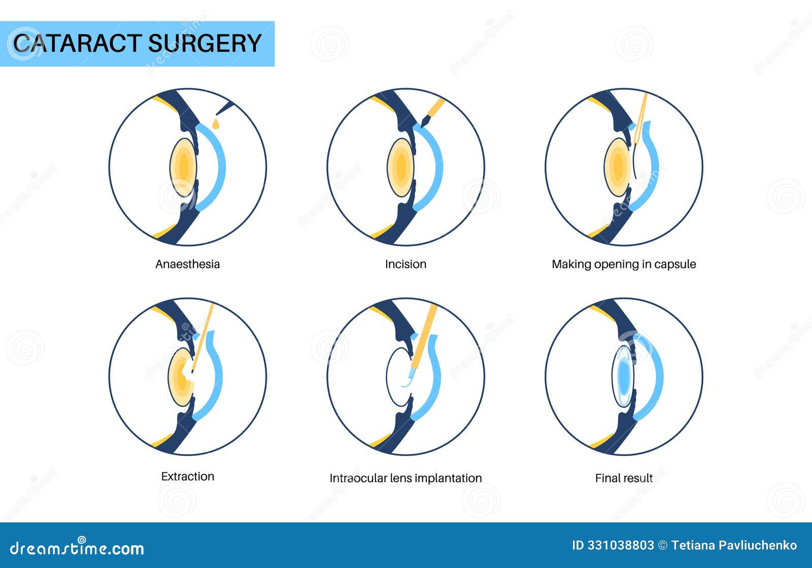 Cataract surgery poster stock illustration. Illustration of diagram ...