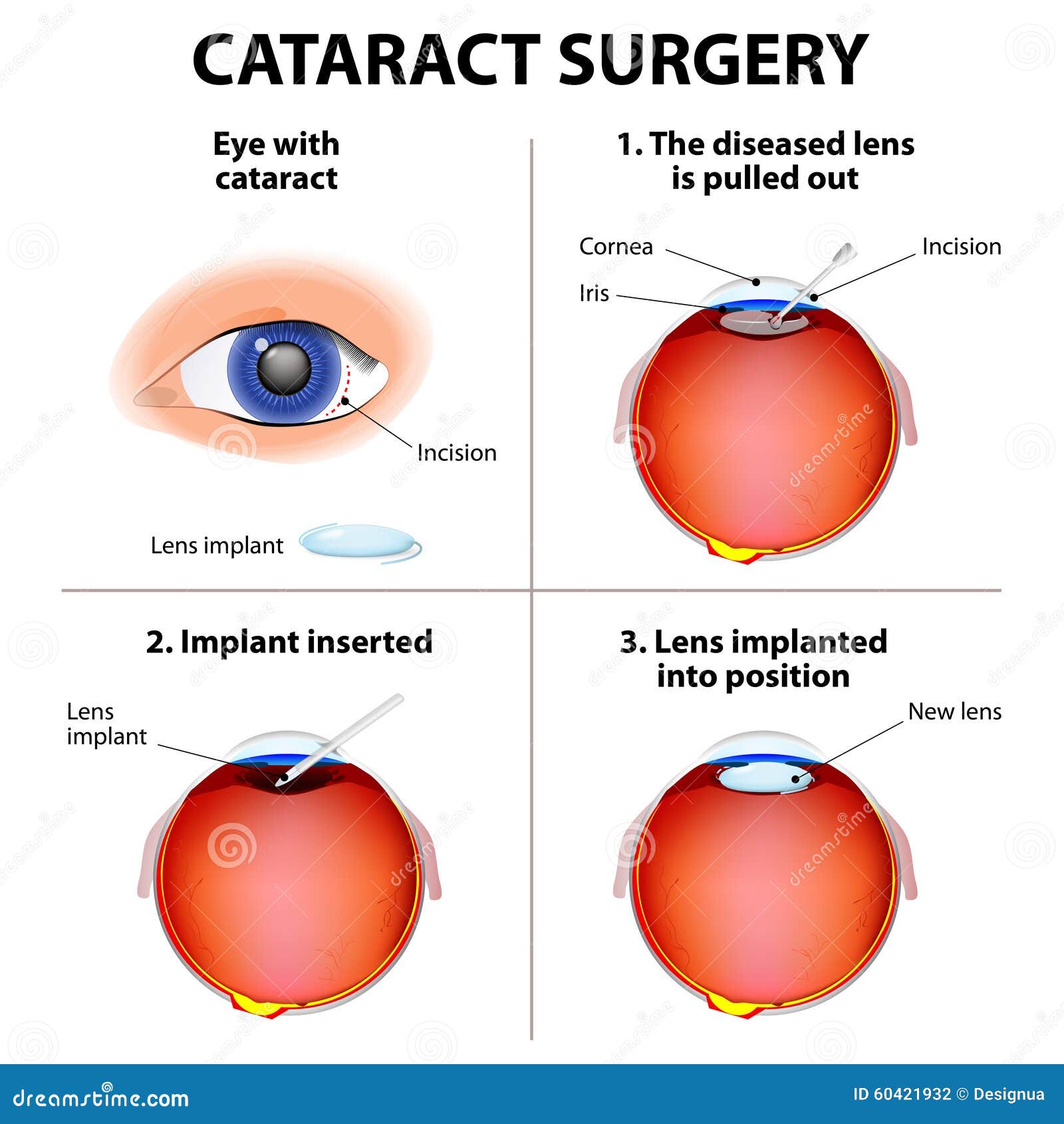The Structure Of The Eye. Cataract Cartoon Vector | CartoonDealer.com ...