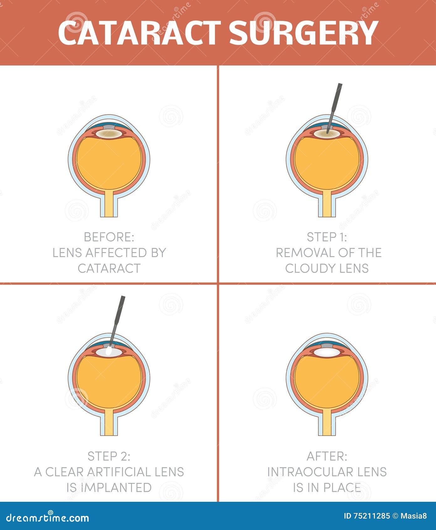 Cataract surgery, stock illustration. Illustration of disease - 75211285