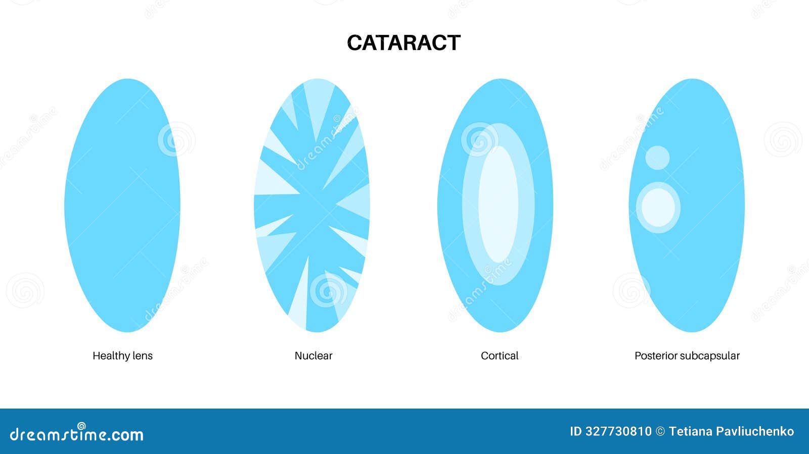 Cataract eye disease stock illustration. Illustration of vector - 327730810