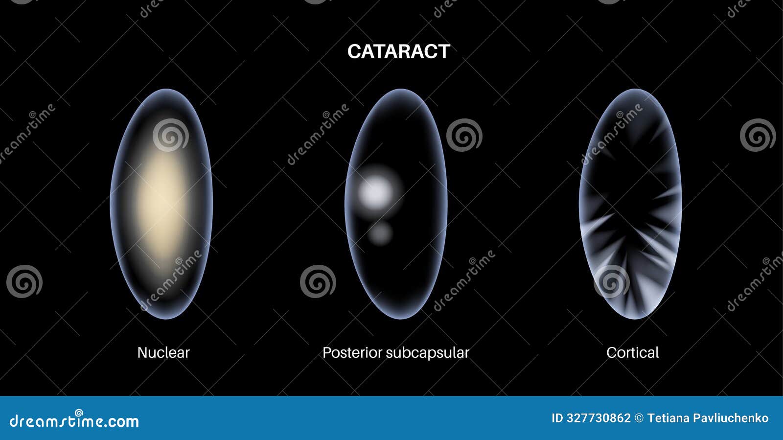 Cataract eye disease stock illustration. Illustration of intraocular ...