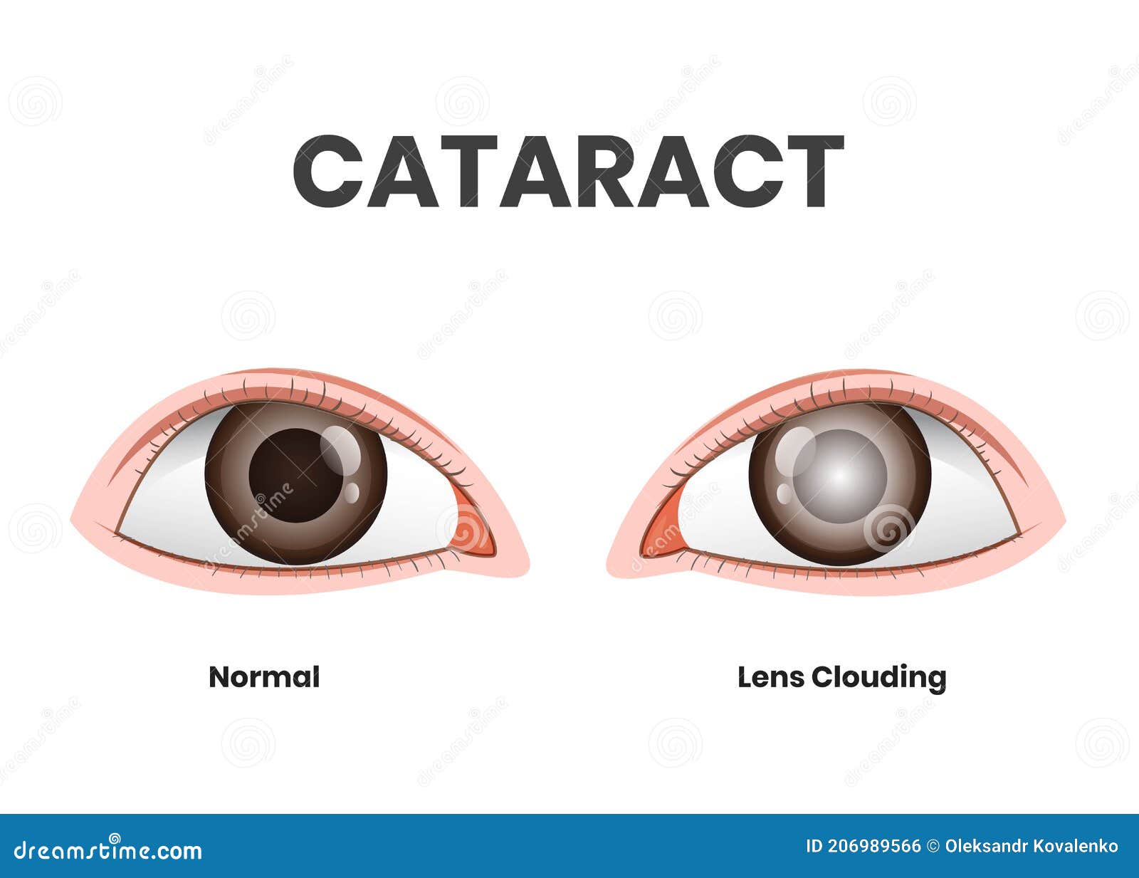 Eye Diseases Cataract