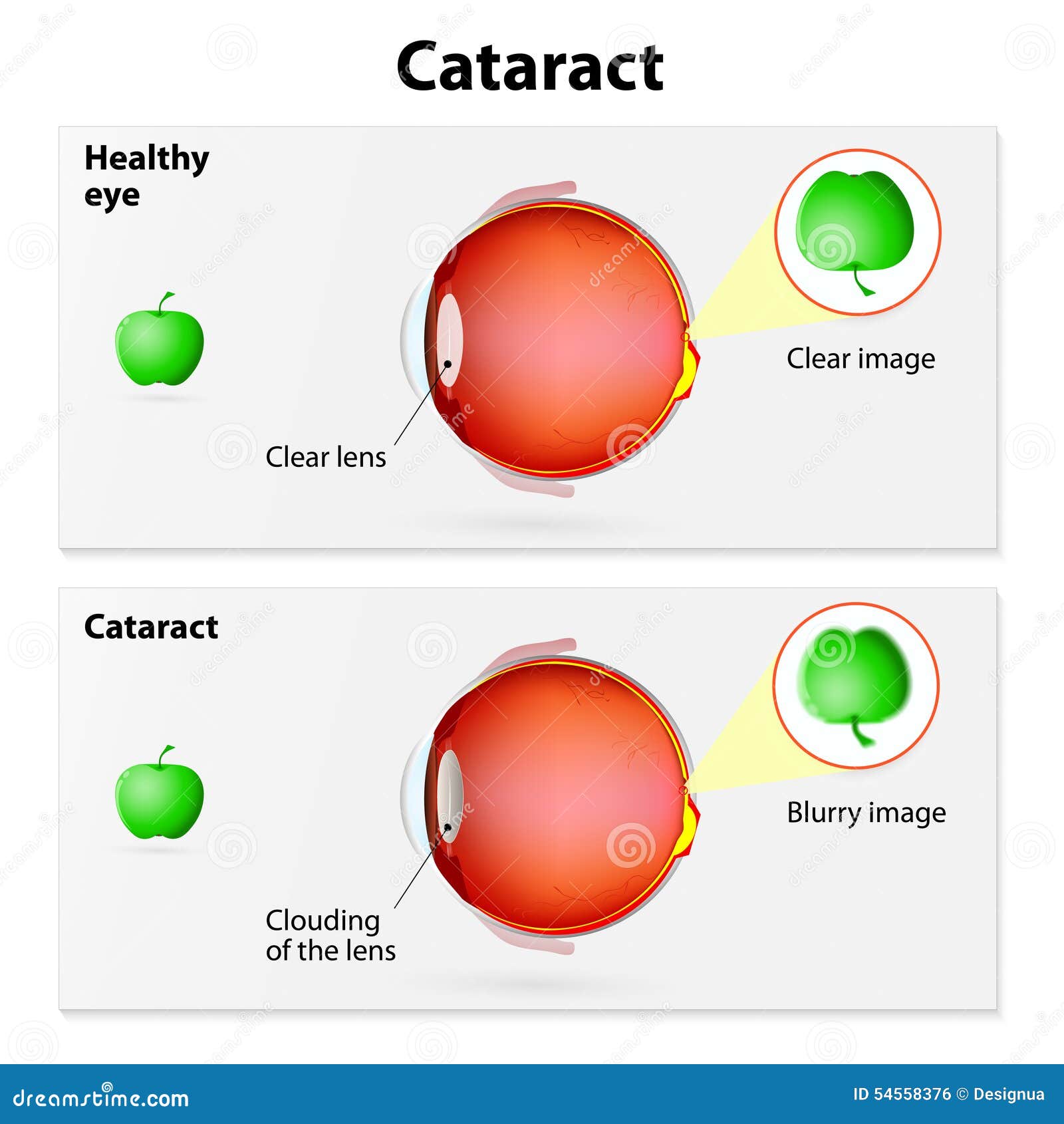 Cataratta illustrazione vettoriale. Illustrazione di occhio - 54558376