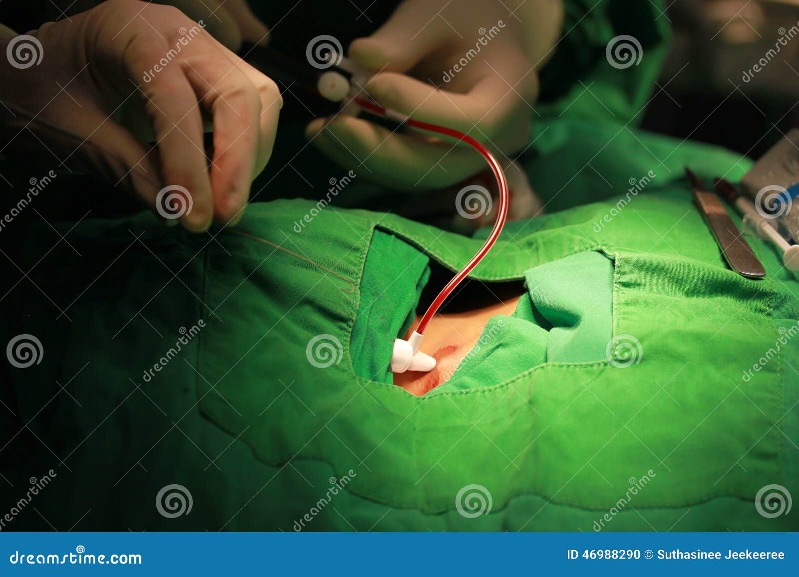 Cateterización Interna De La Vena Yugular Foto de archivo - Imagen de ...