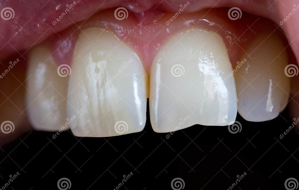Caucasian man top teeth stock image. Image of teeth, next - 25826693