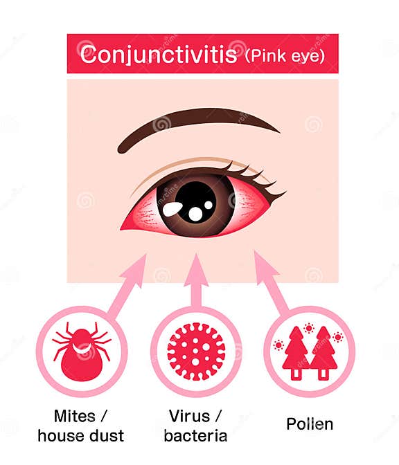 Causas De Conjuntivitis Ilustración De Vector Ocular Rosa Ilustración