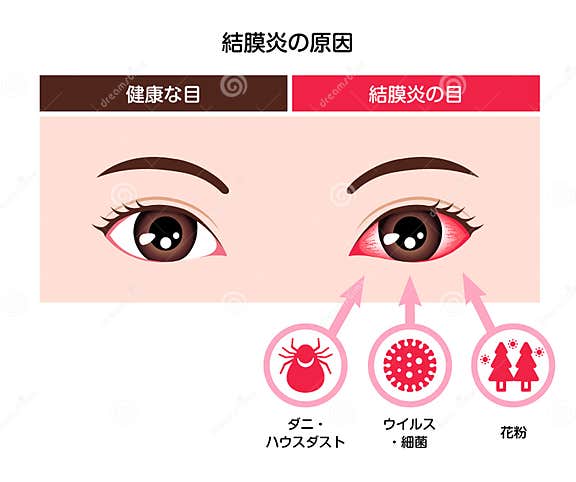 Causas De Conjuntivitis Ilustración De Vector Ocular Rosa Ilustración