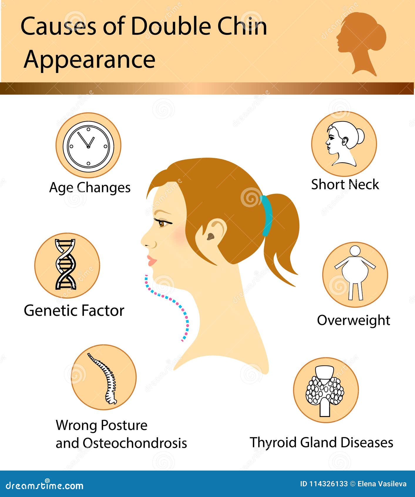Causas De La Barbilla Doble Ilustración del Vector - Ilustración de ...