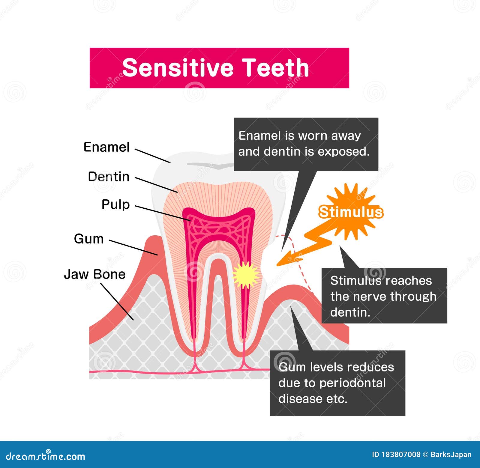 Cause and Mechanism of Sensitive Teeth Illustration Stock Vector ...