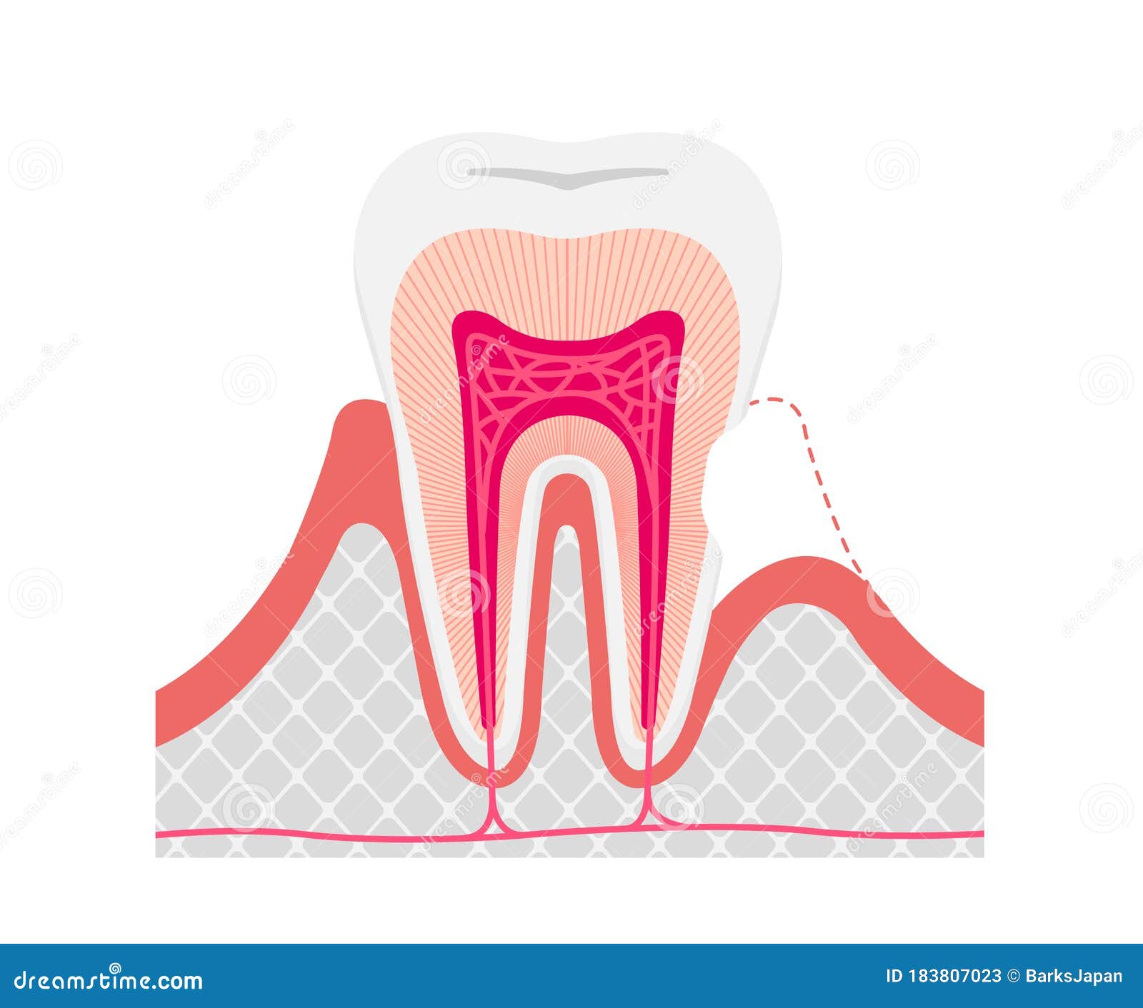 Cause and Mechanism of Sensitive Teeth Vector Illustration / No Text ...