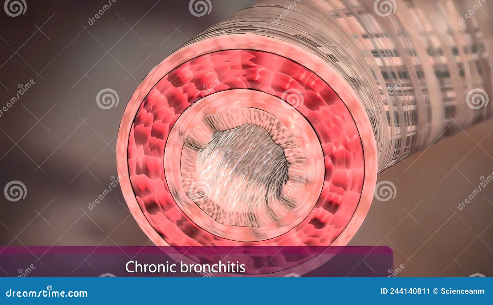 It is Caused by Ecessive Mucus Production and Secretion in Chronic ...