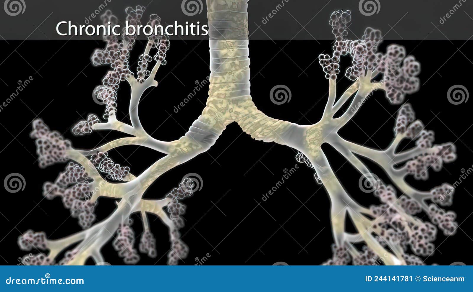 It is Caused by Ecessive Mucus Production and Secretion in Chronic ...