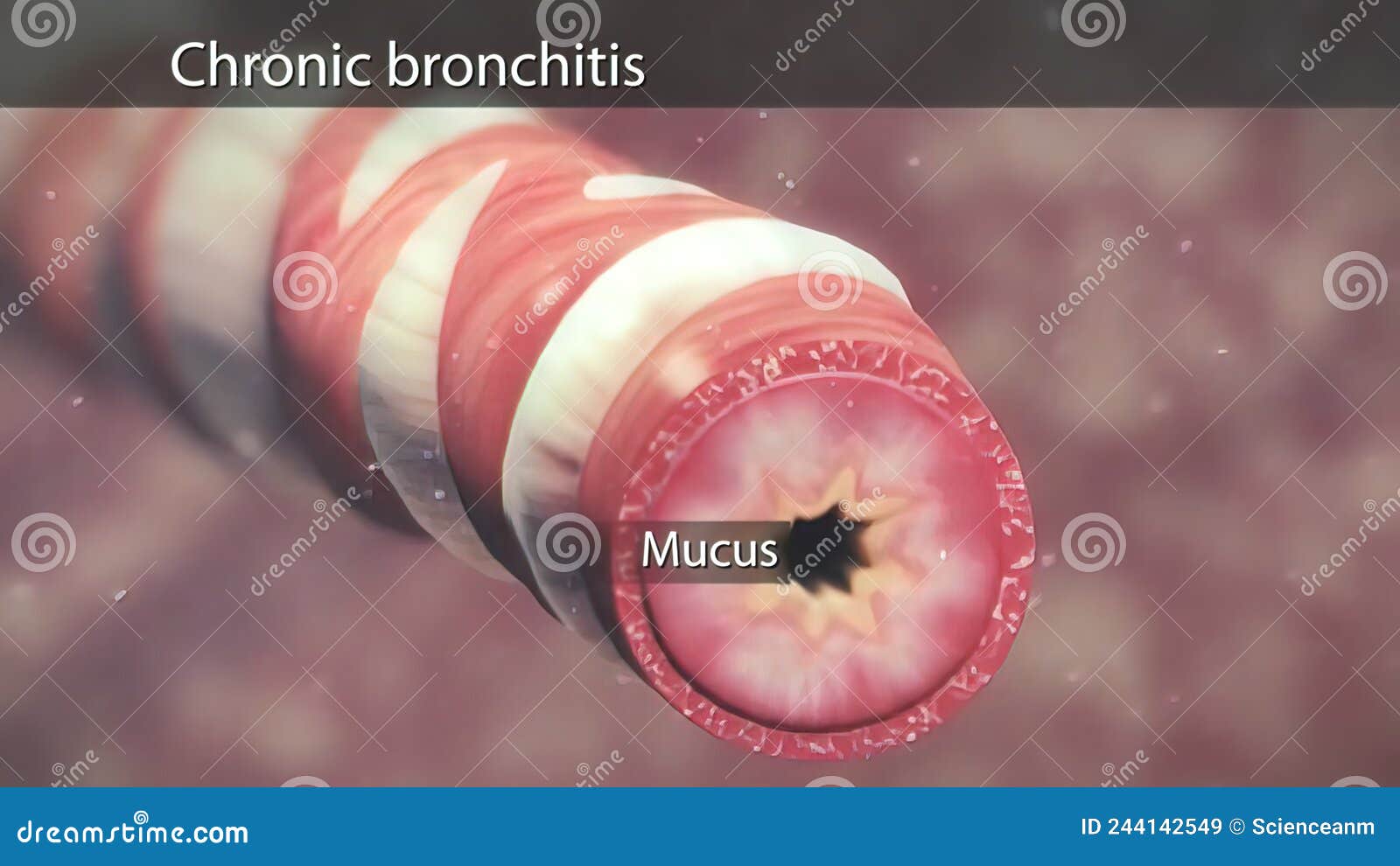 It is Caused by Ecessive Mucus Production and Secretion in Chronic ...