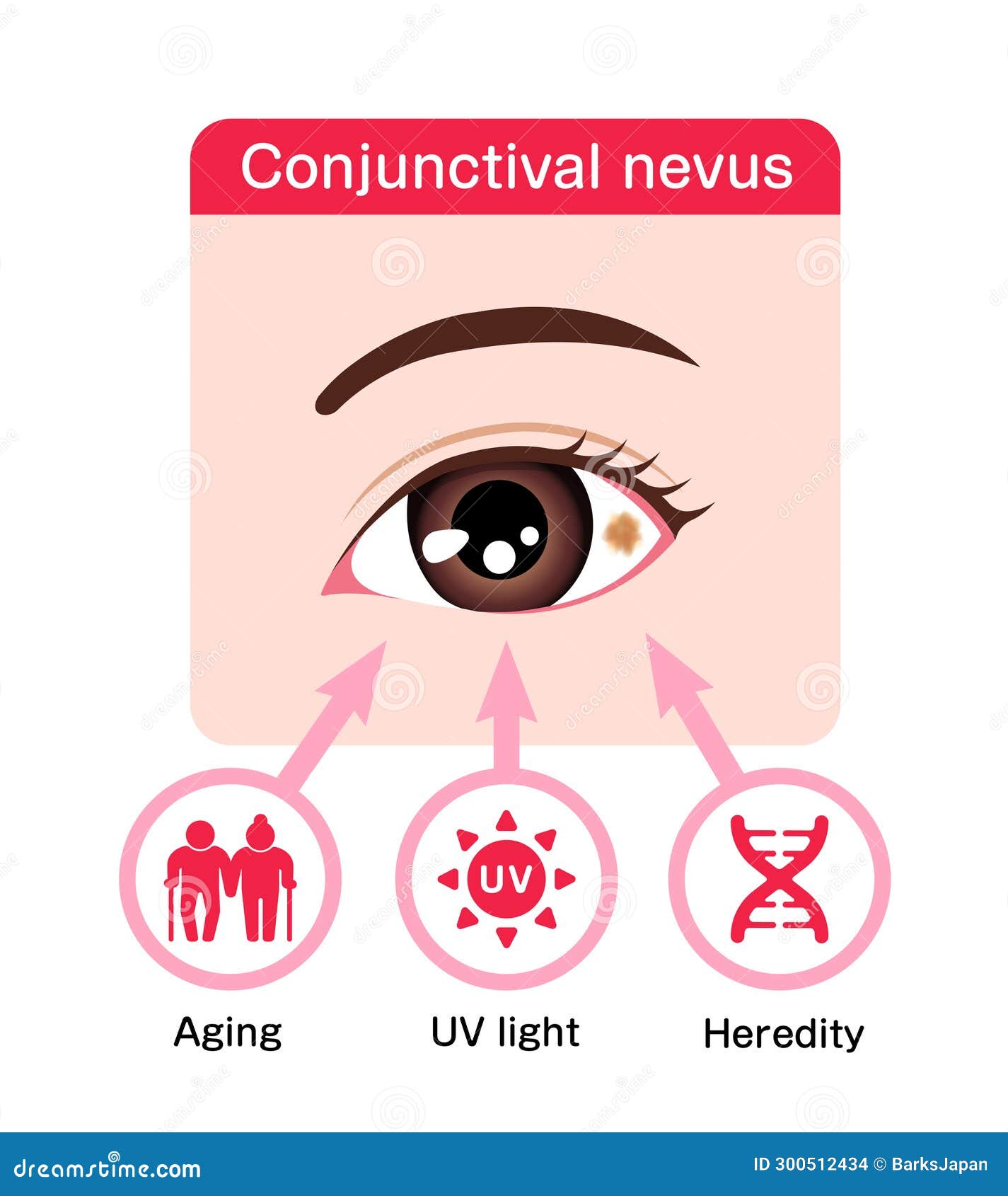 Causes Of Conjunctival Nevus Vector Illustration | CartoonDealer.com ...
