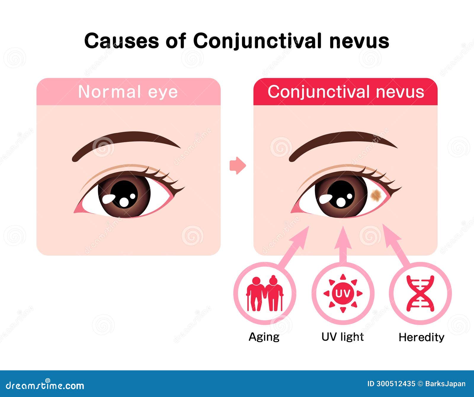 Causes of Conjunctival Nevus Vector Illustration Stock Vector ...