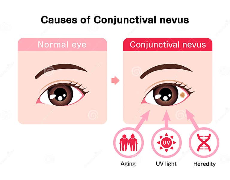 Causes of Conjunctival Nevus Vector Illustration Stock Vector ...